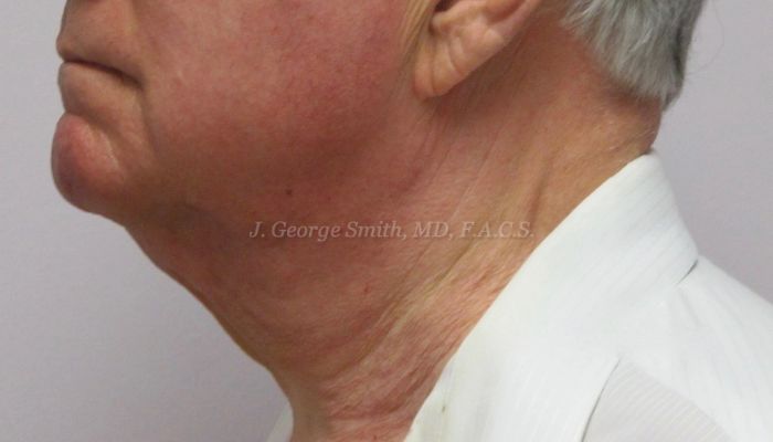 Acculift Case 2024 - Faces, PLLC in Ridgeland, MS