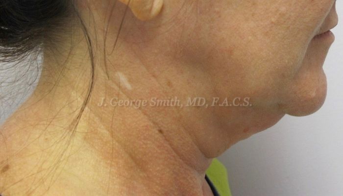 Acculift Case 2030 - Faces, PLLC in Ridgeland, MS