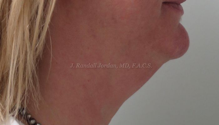 Acculift Case 2033 - Faces, PLLC in Ridgeland, MS