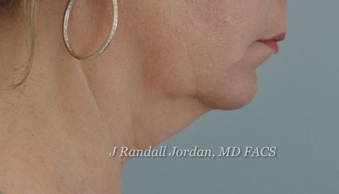 Acculift Case 3702 - Faces, PLLC in Ridgeland, MS