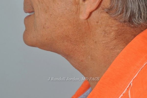 Neck Lift Case 4277 - Faces, PLLC in Ridgeland, MS