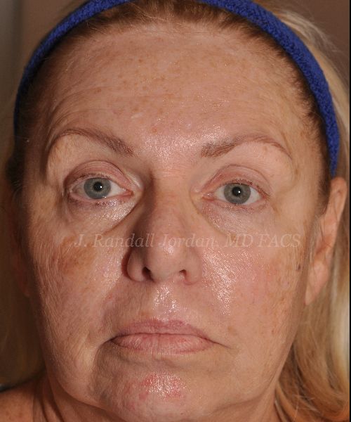 Deep Chemical Peels Case 4998 - Faces, PLLC in Ridgeland, MS