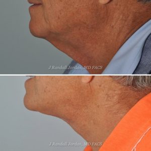Neck Lift for Men | Male Neck Rejuvenation | Faces in Jackson, MS