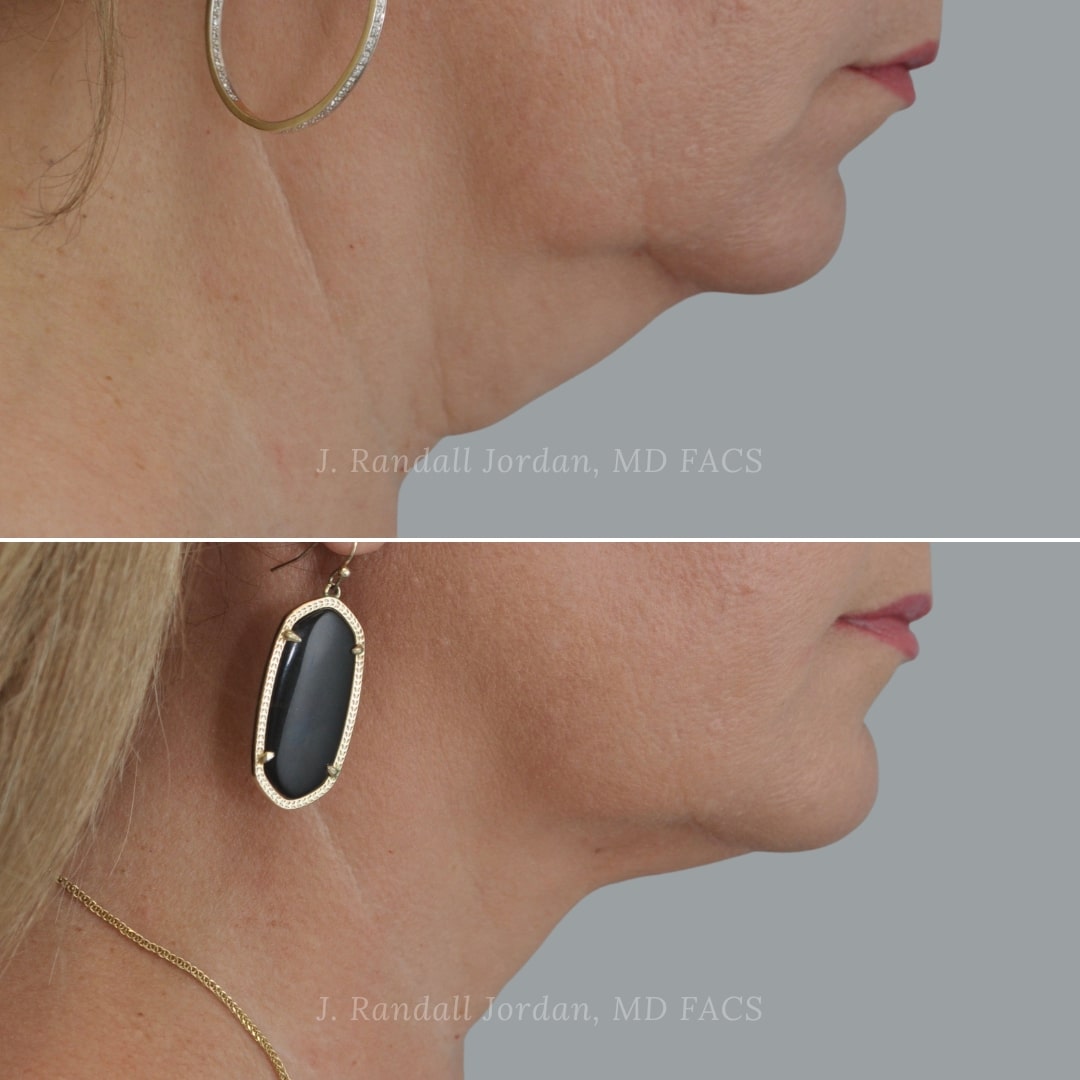 AccuLift RF in Jackson, MS | Neck Liposuction + Skin Tightening | Faces