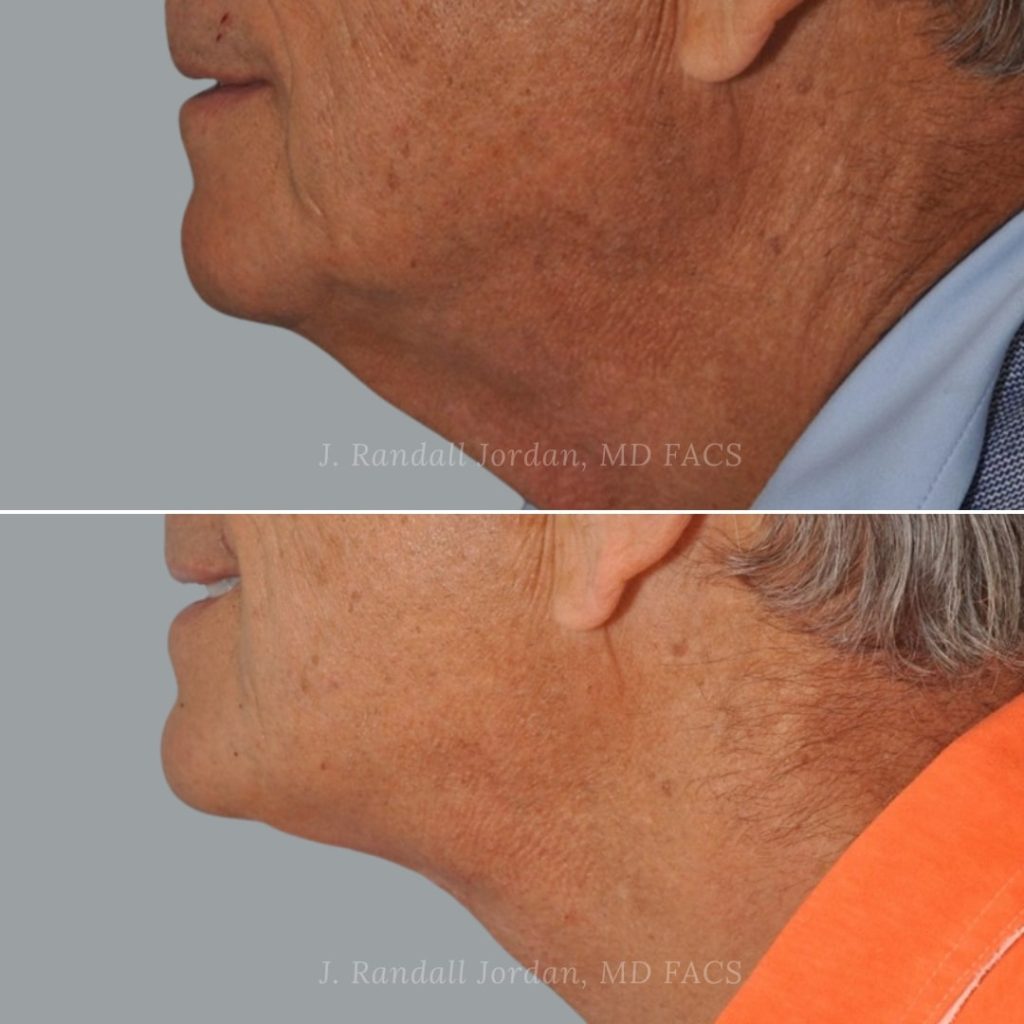 Neck Lift for Men | Male Neck Rejuvenation | Faces in Jackson, MS